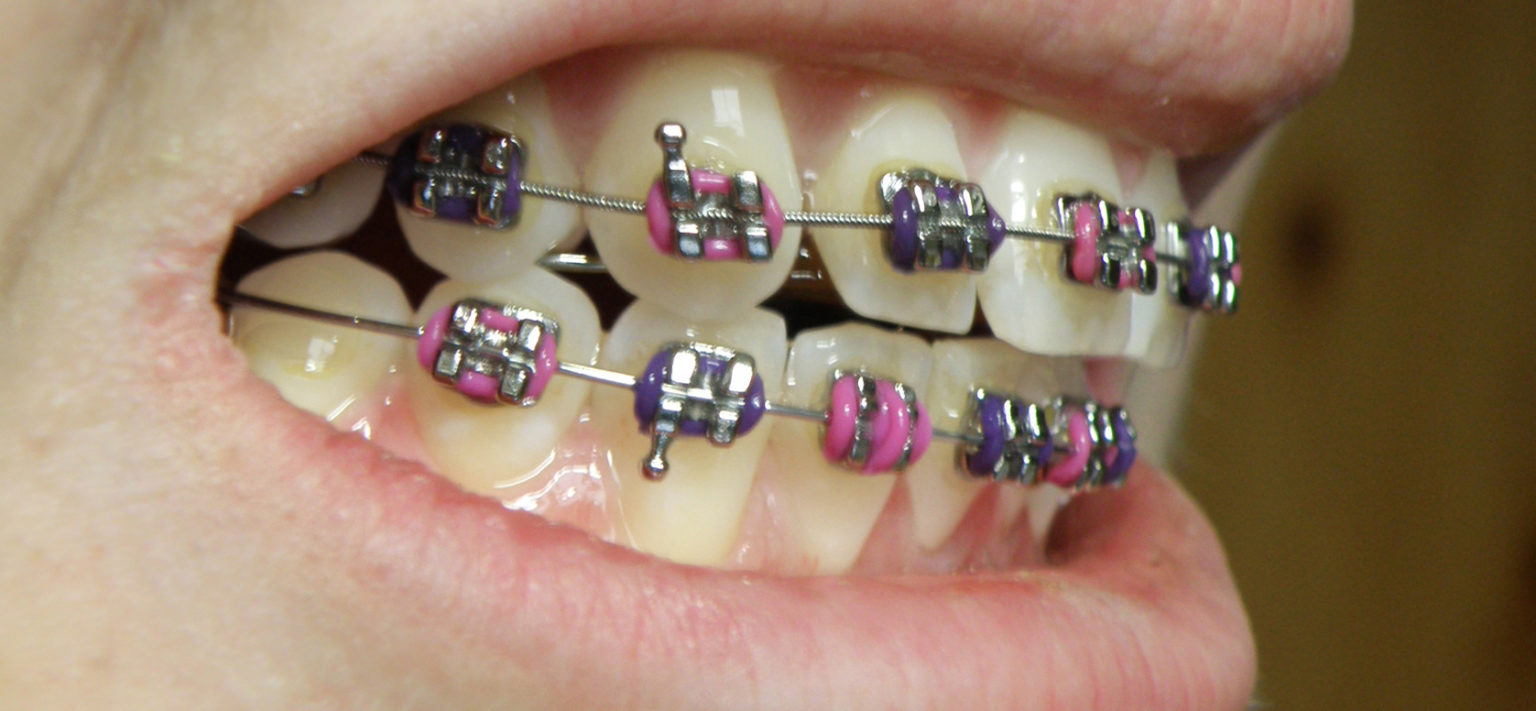 Different types of Braces