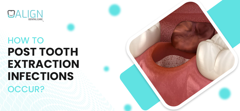 Infection after a tooth extraction