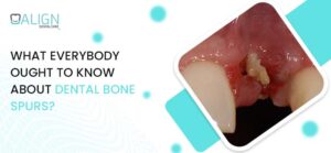 Dental Bone Spurs : Common Cause and Effective Dental Treatments